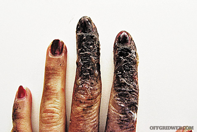 How to Identify and Treat Thermal Burns | RECOIL OFFGRID