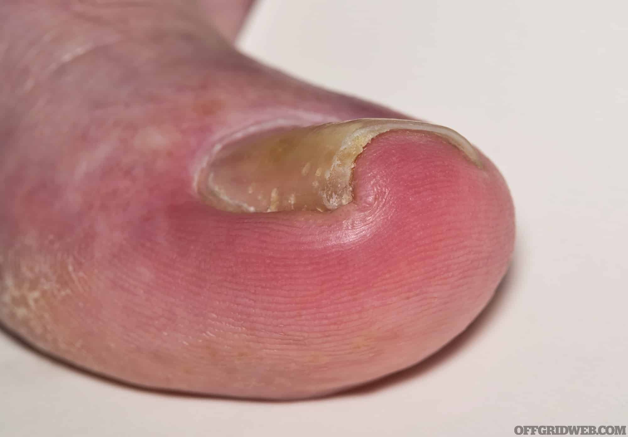 Foot Care in Off-The-Grid Situations: When Your Dogs are Howling ...