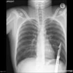 How to Treat Penetrating Chest Wounds | RECOIL OFFGRID