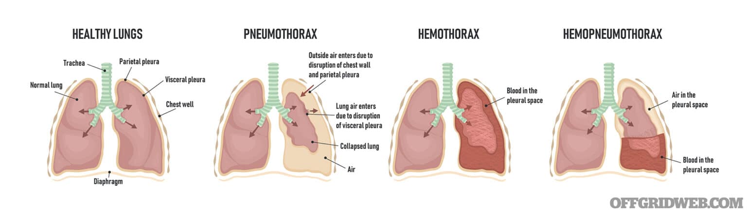 How to Treat Penetrating Chest Wounds | RECOIL OFFGRID